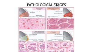 Non Resolving Pneumonia | PPTX