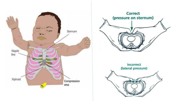 Neonatal resuscitation protocol of pediatric.pptx