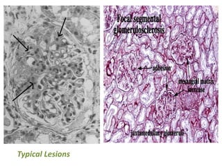 Nephrotic syndrome | PPTX