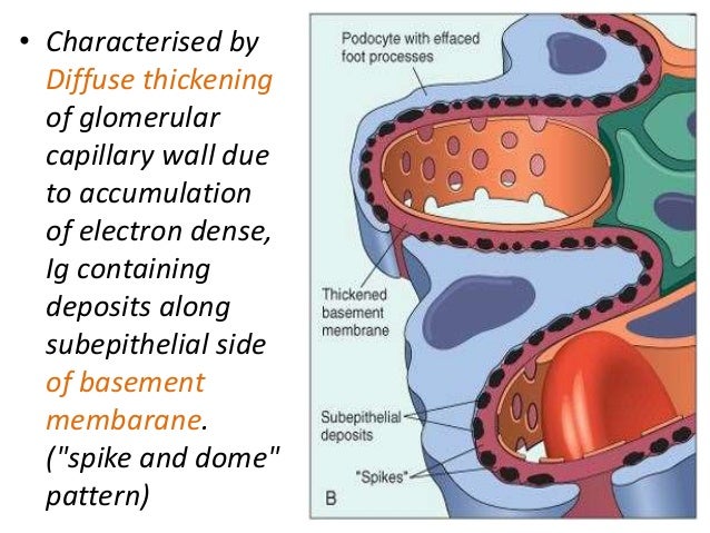 Nephrotic syndrome