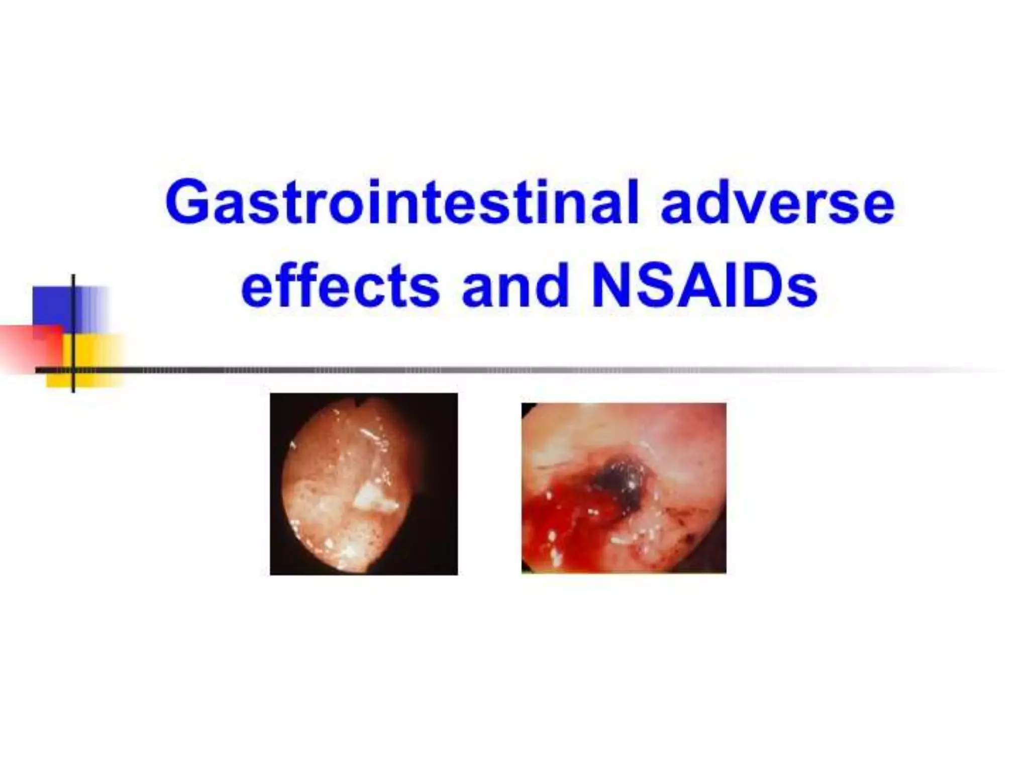 NSAIDs and ICON-G | PPT