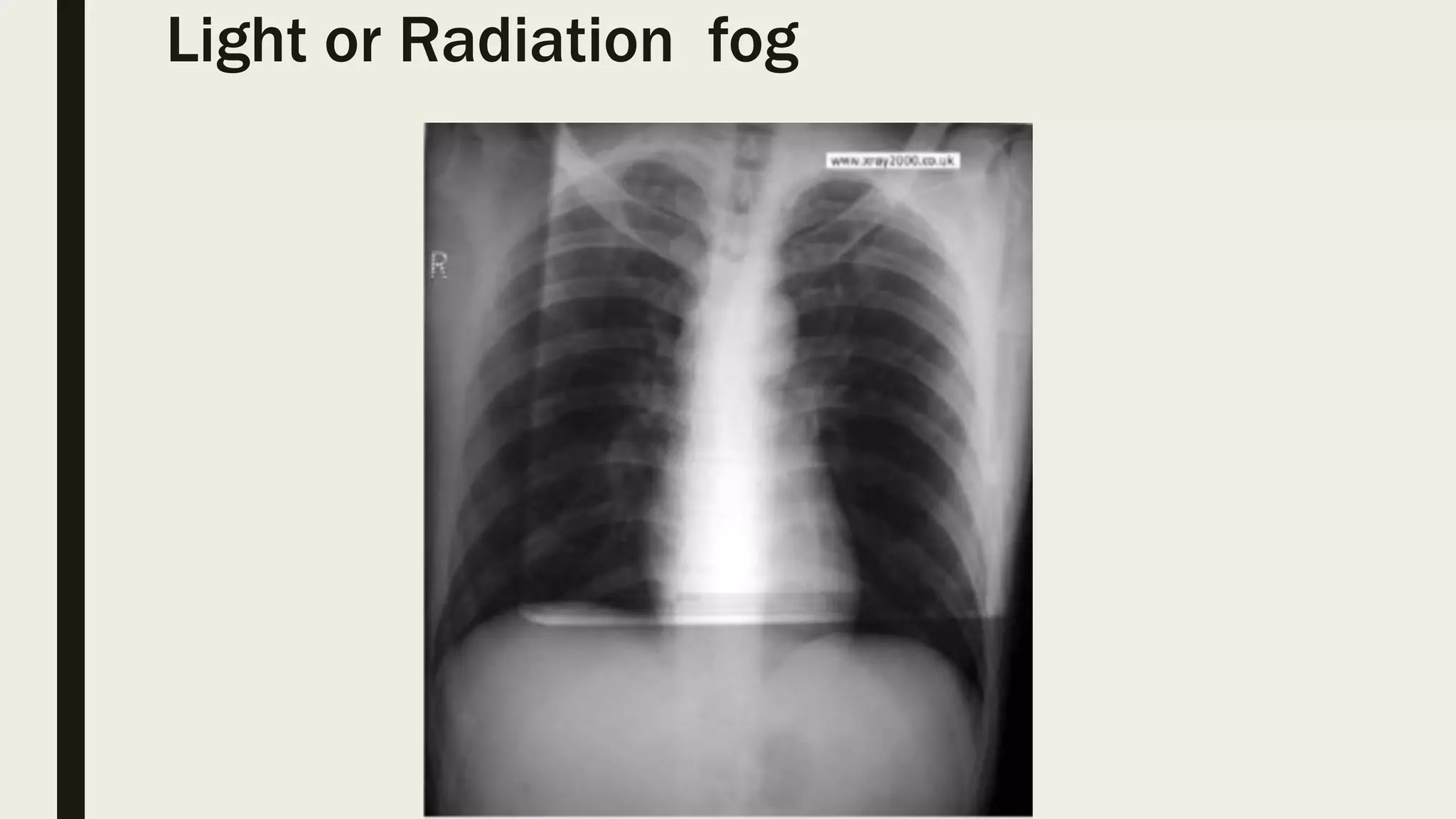 Radiographic screen film artifacts | PPTX