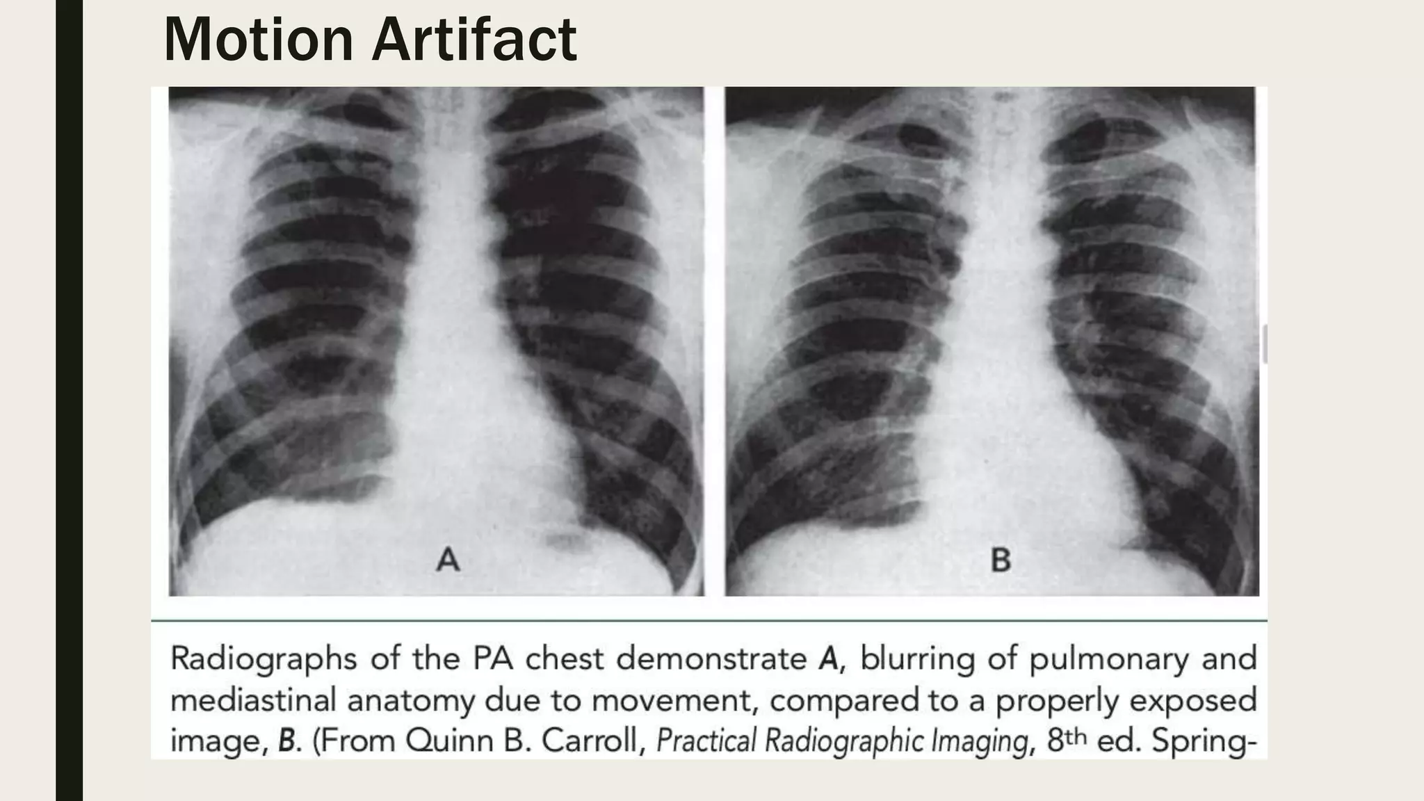 Radiographic screen film artifacts | PPTX