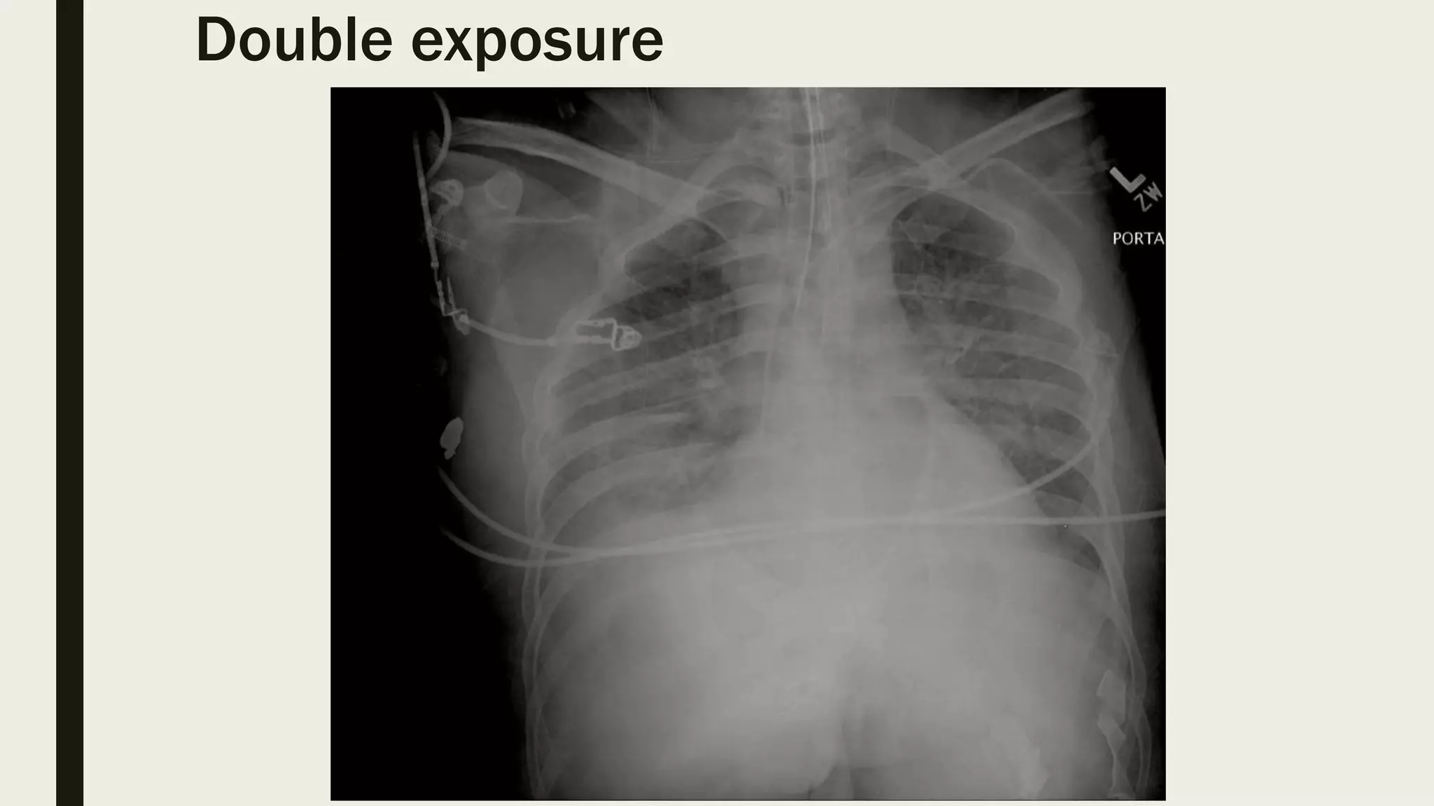 Radiographic screen film artifacts | PPTX
