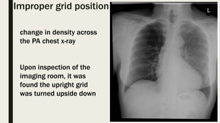 Radiographic screen film artifacts | PPTX