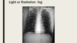 Radiographic screen film artifacts | PPTX | Eye and Vision Conditions ...