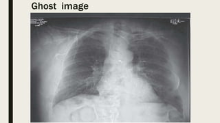 Radiographic screen film artifacts | PPTX