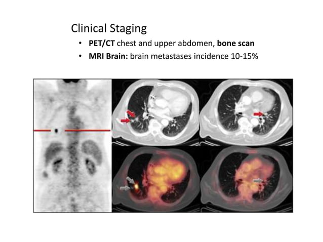 NSCLC management basics | PPTX
