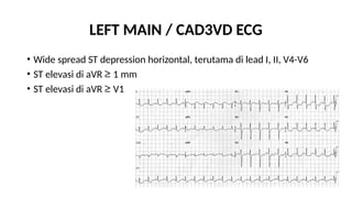 non st elevasi myocardial infarc + Drugs.pptx