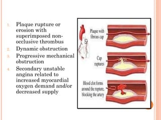 NSTEMI DrHafiz | PPT