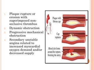 NSTEMI DrHafiz | PDF