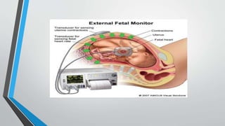 Non-stress test, and contraction stress test, presentation | PPTX