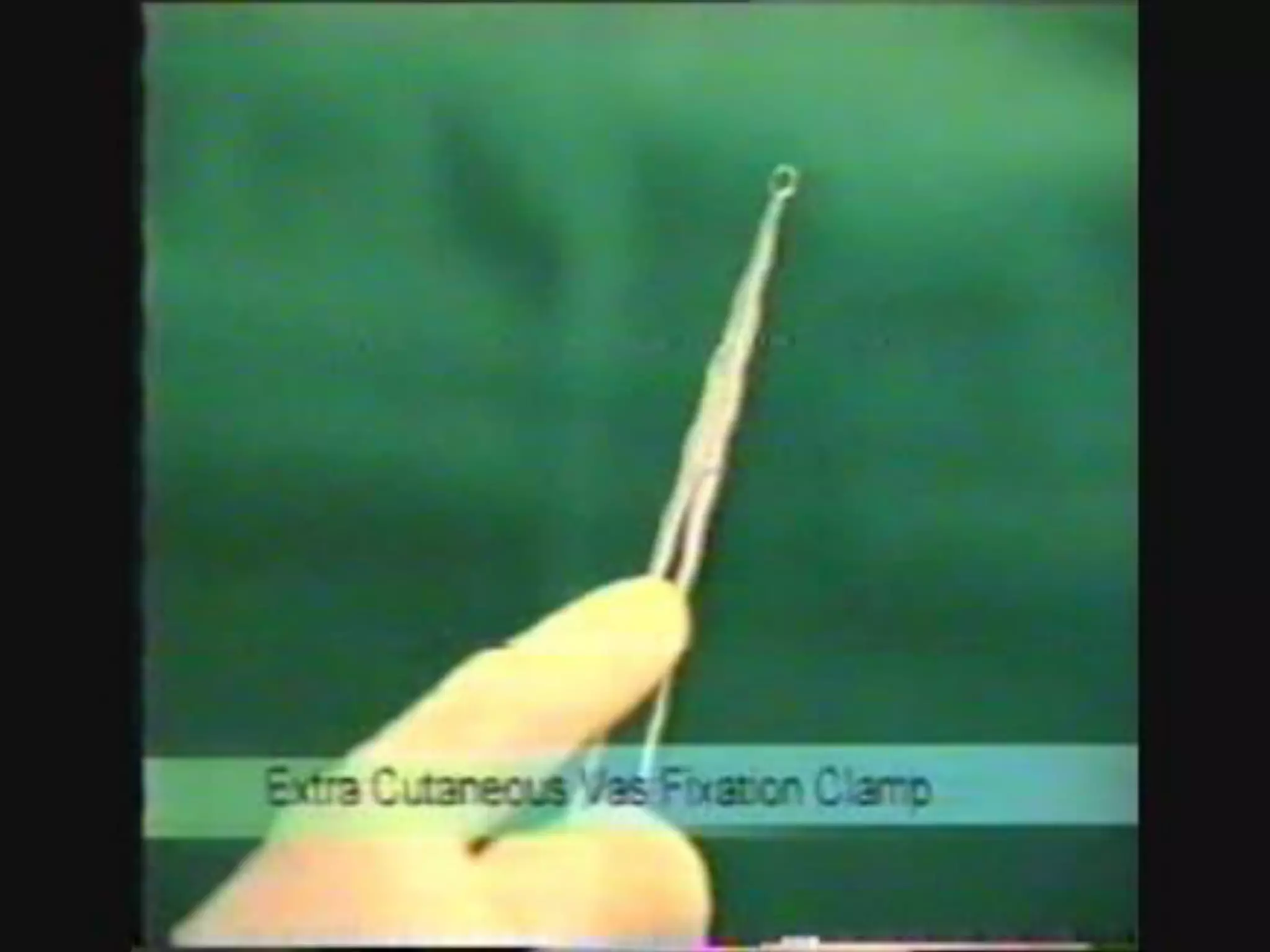 NO SCALPEL VASECTOMY(NSV) | PDF
