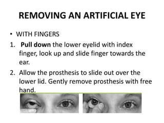 Nt6 health education of eye tumour revised | PPTX