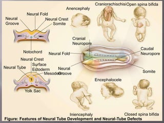 NEURAL TUBE DEFECTS (NTDs) IN INFANTS | PPTX | Pregnancy | Reproductive ...