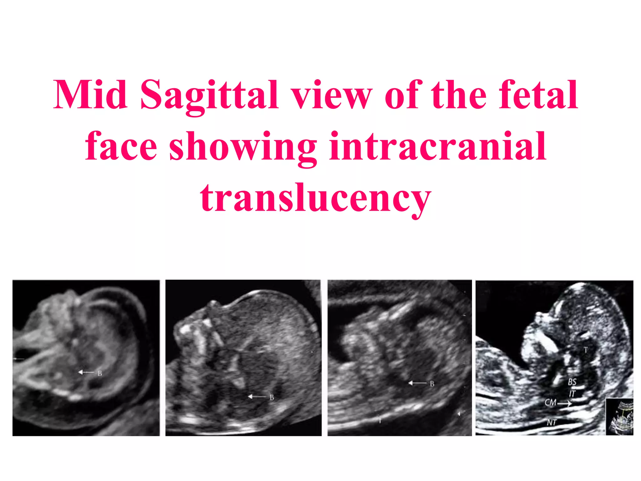 Antenatal Biochemical & ULTRASOUND SCREENING for FETAL CHROMOSOMAL ...
