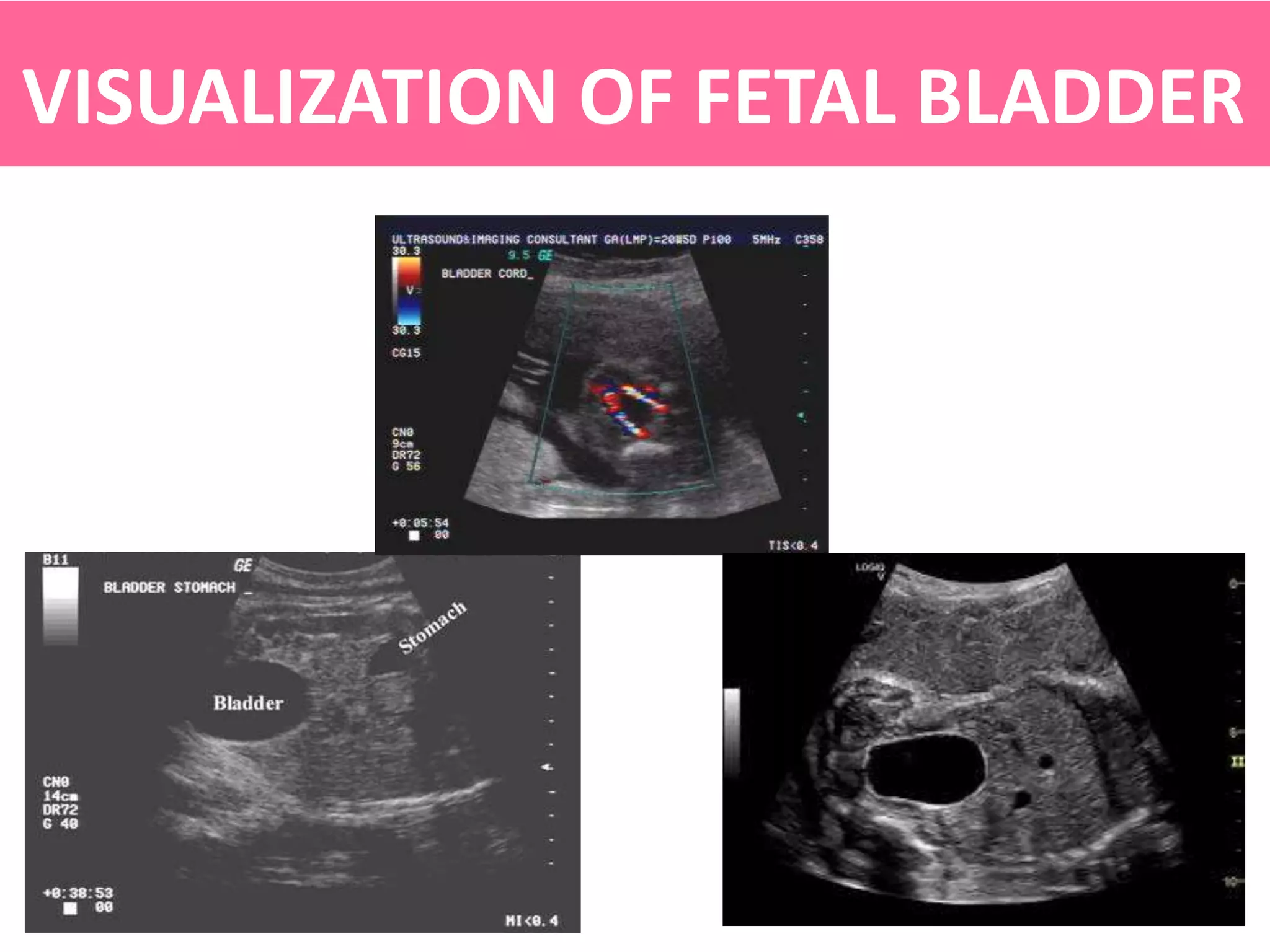 Antenatal Biochemical & ULTRASOUND SCREENING for FETAL CHROMOSOMAL ...