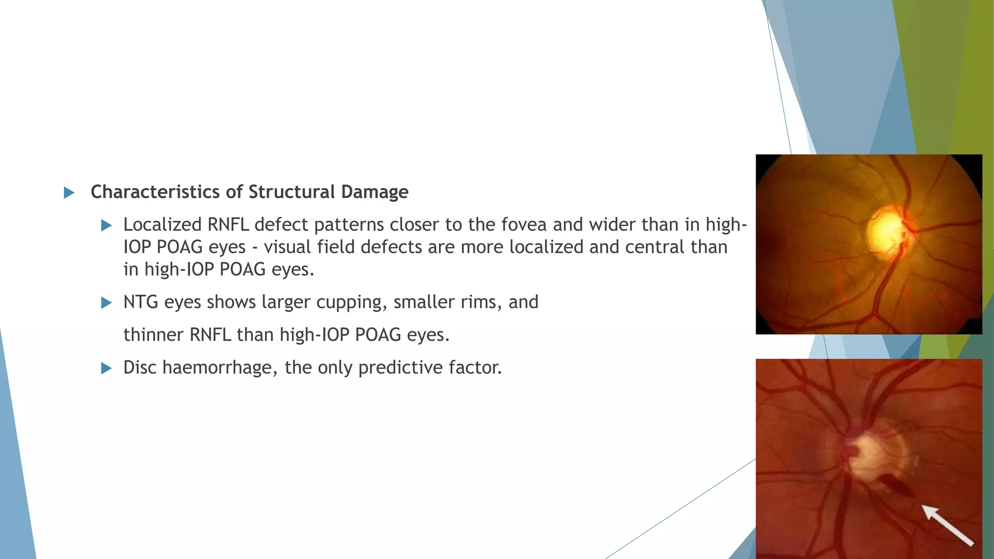Normal Tension Glaucoma | PPTX
