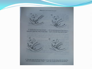 NTH_GIÃN ĐẠI TRÀNG BẨM SINH - thầy Hùng.pdf