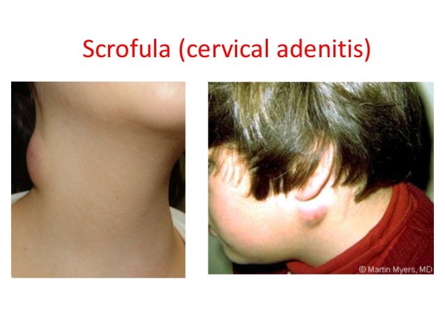 Non tuberculous mycobacteria
