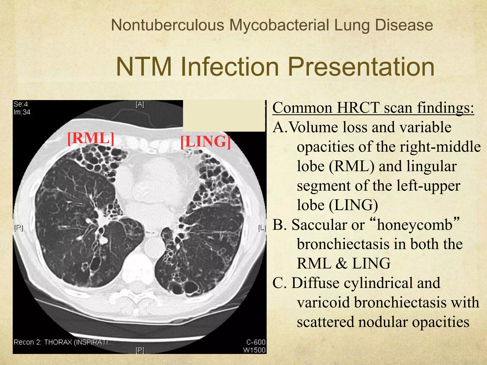 ATYPICAL MYCOBACTERIA | PPTX