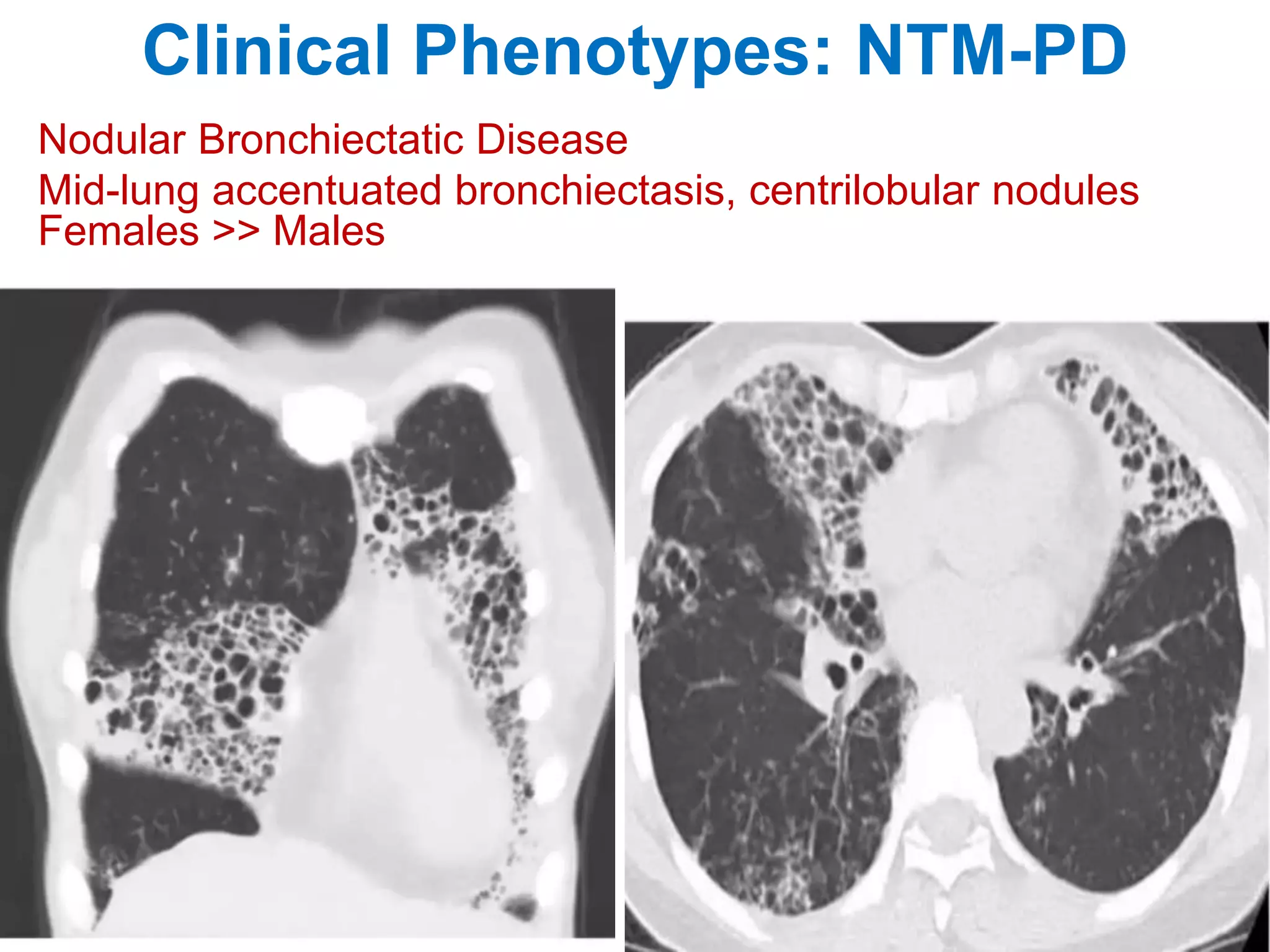 Non Tuberculous Mycobacteria | PPTX