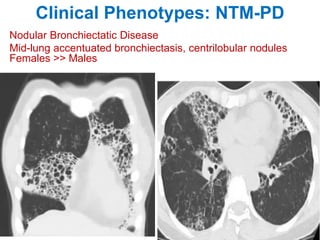 Non Tuberculous Mycobacteria | PPTX