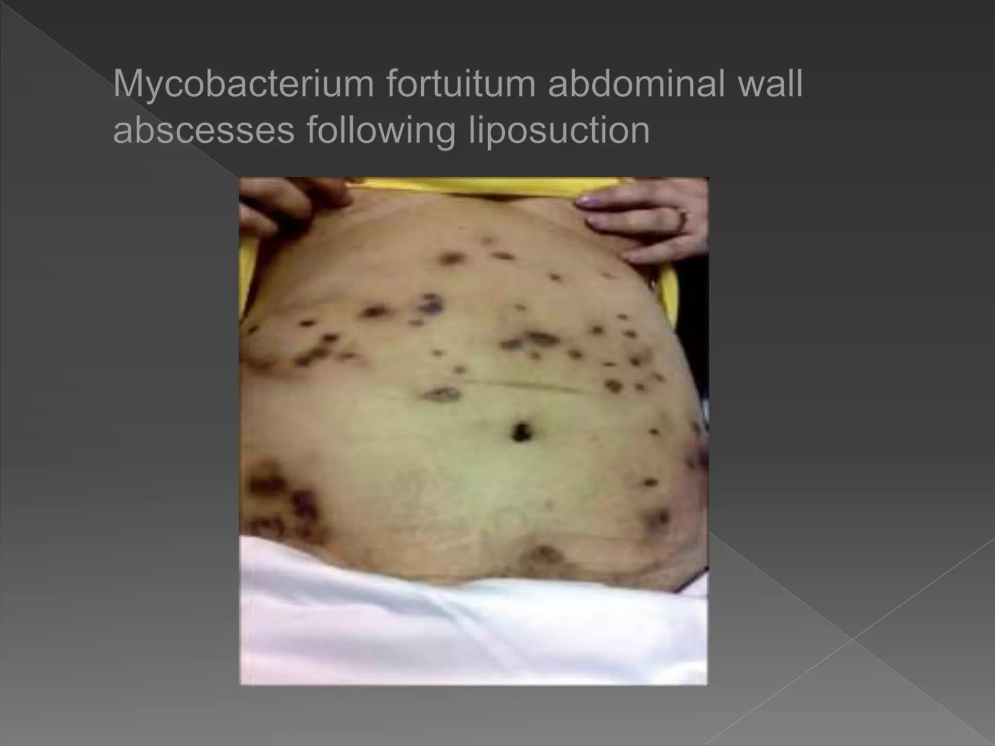 NTM | PPTX | Diseases and Conditions | Medical Health