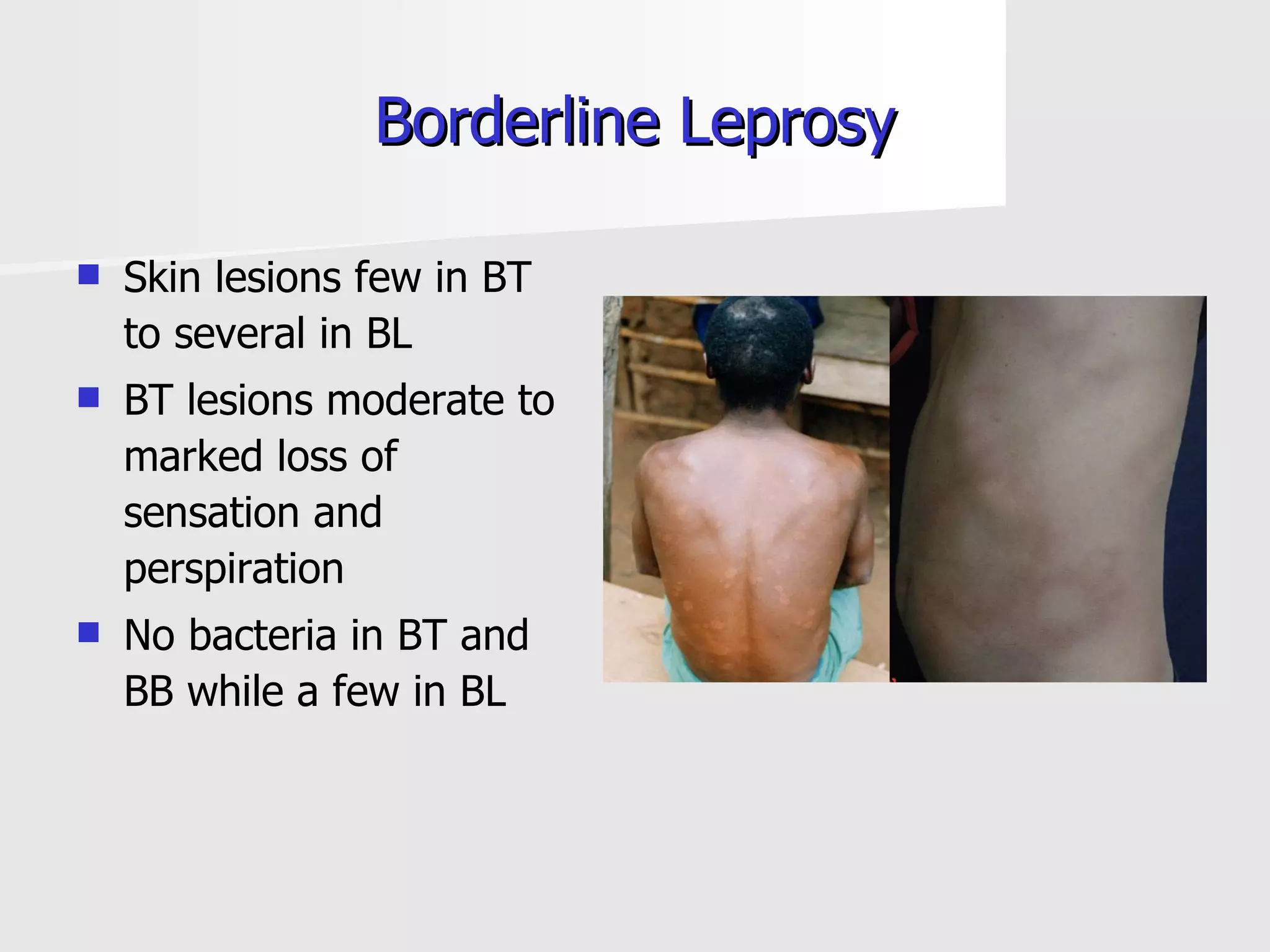 Ntm m leprae leprosy | PPT