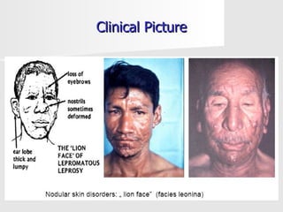 Leprosy Lion Face
