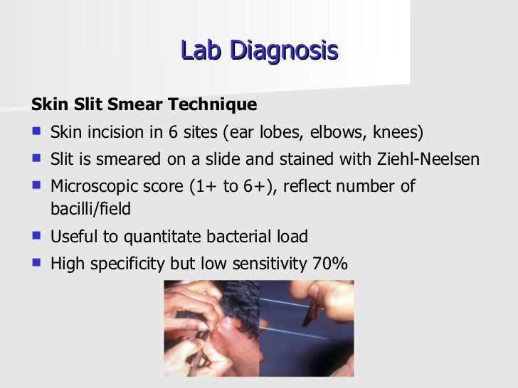 Ntm m leprae leprosy