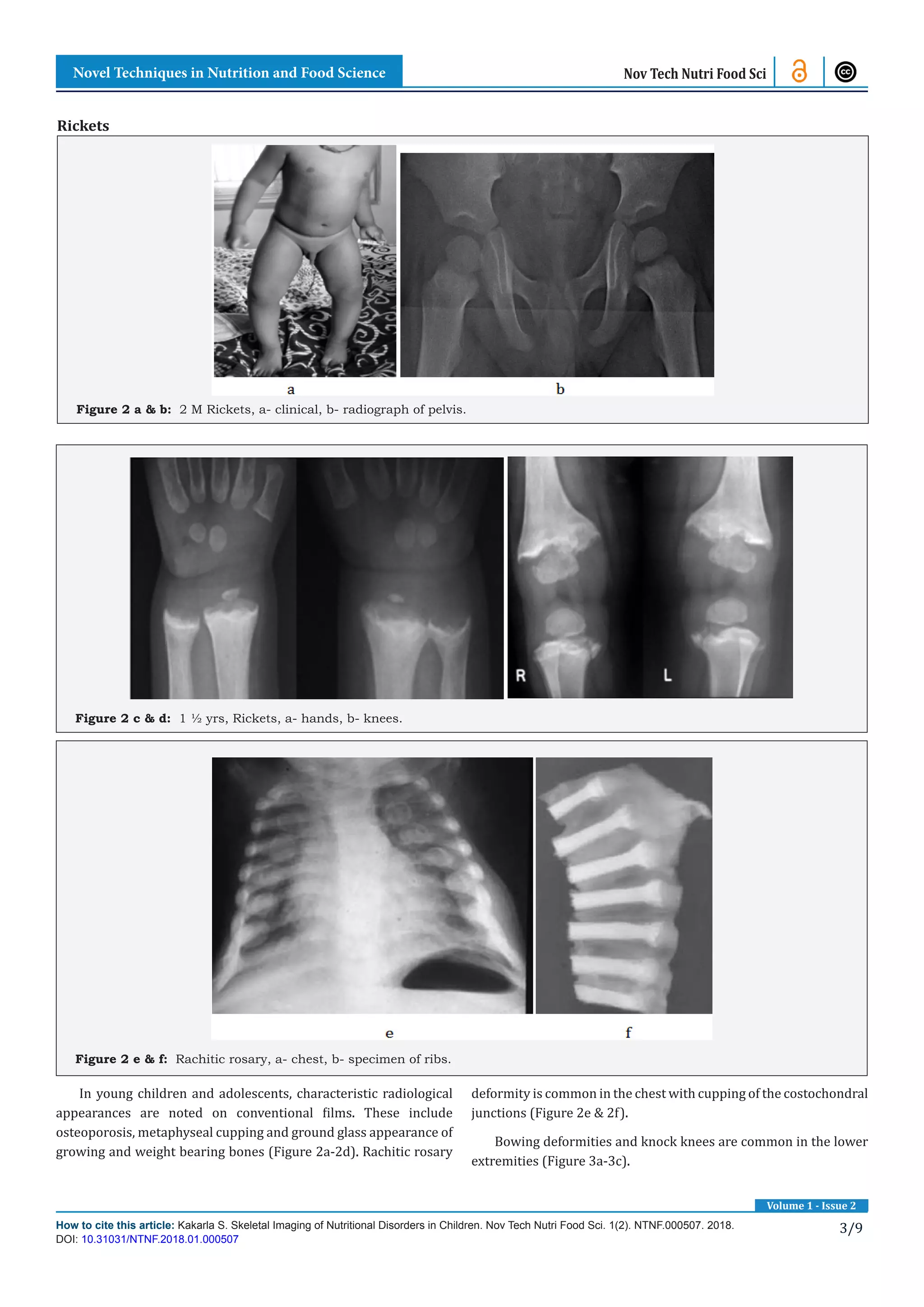 Skeletal Imaging of Nutritional Disorders in Children_Crimson ...