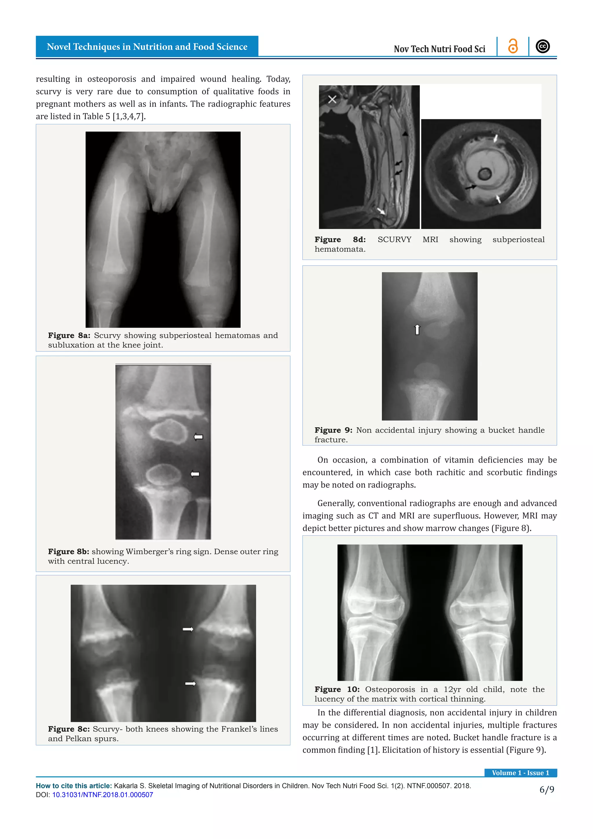 Skeletal Imaging of Nutritional Disorders in Children_Crimson ...