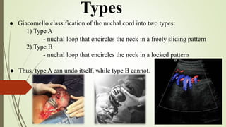 Cord-Around-the Neck (Nuchal Cord) - Rivin | PPTX