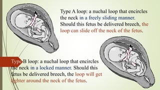Cord-Around-the Neck (Nuchal Cord) - Rivin | PPTX