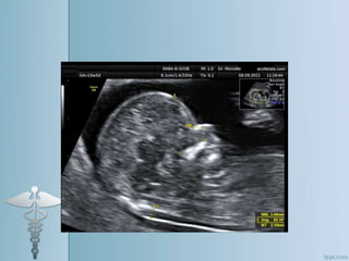 Nuchal translucency | PPTX