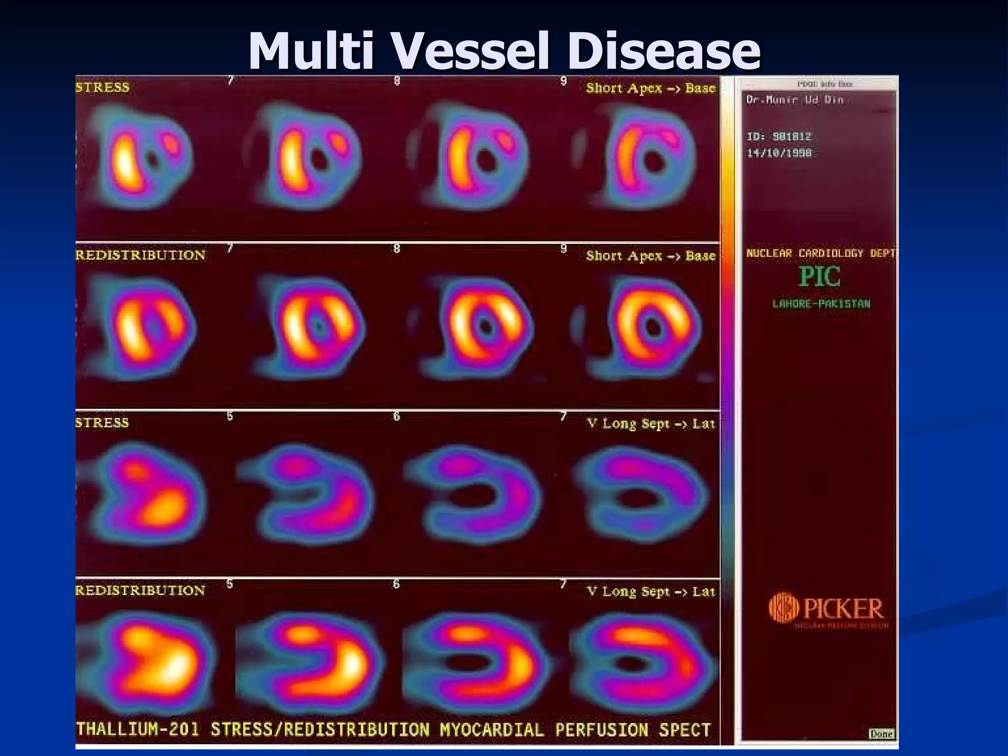 Nuclear Imaging In Cardiology Cme | PPT