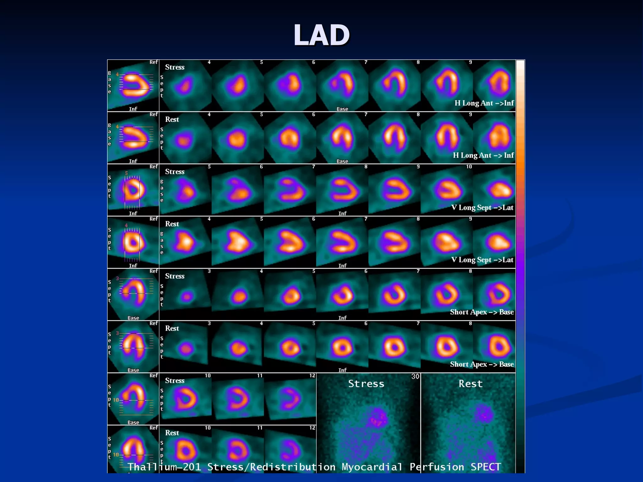Nuclear Imaging In Cardiology Cme | PPT