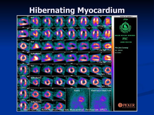 Nuclear Imaging In Cardiology Cme | PPT | Heart and Cardiovascular ...