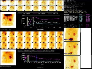 Nuclear imaging in kidney disease | PPT