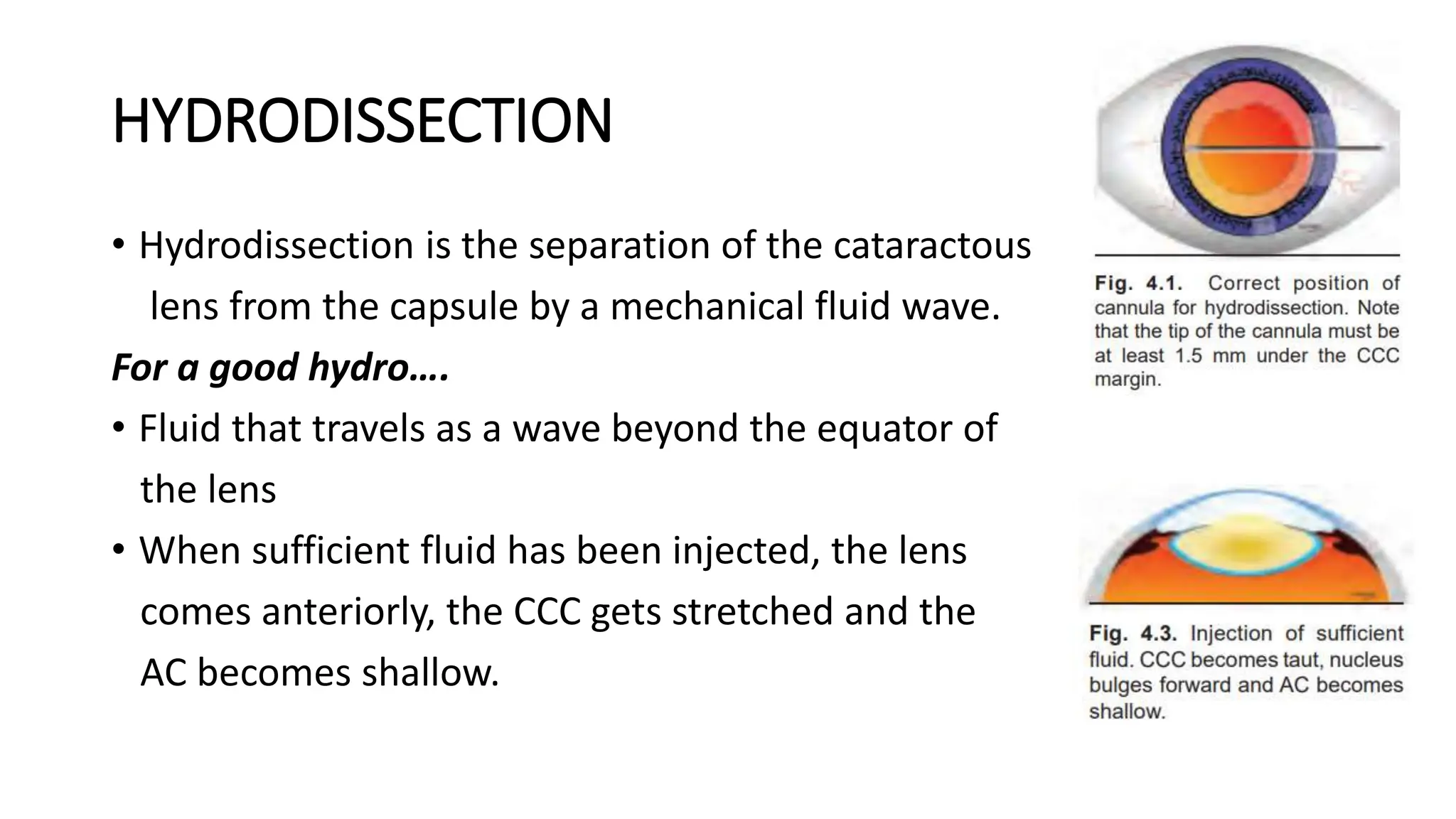 Phaco emulsification nuclear management techniques | PPTX