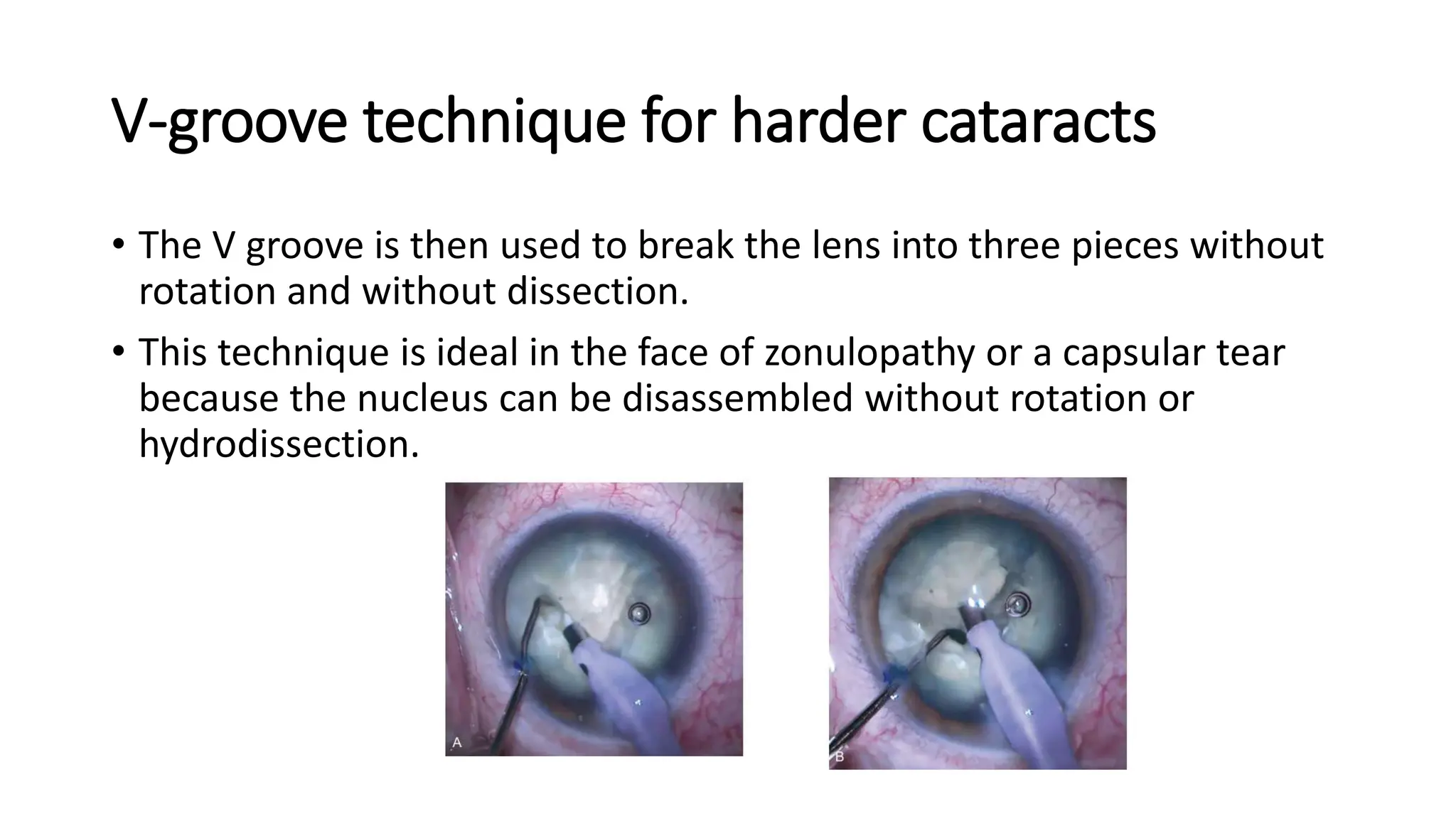 Phaco emulsification nuclear management techniques | PPTX