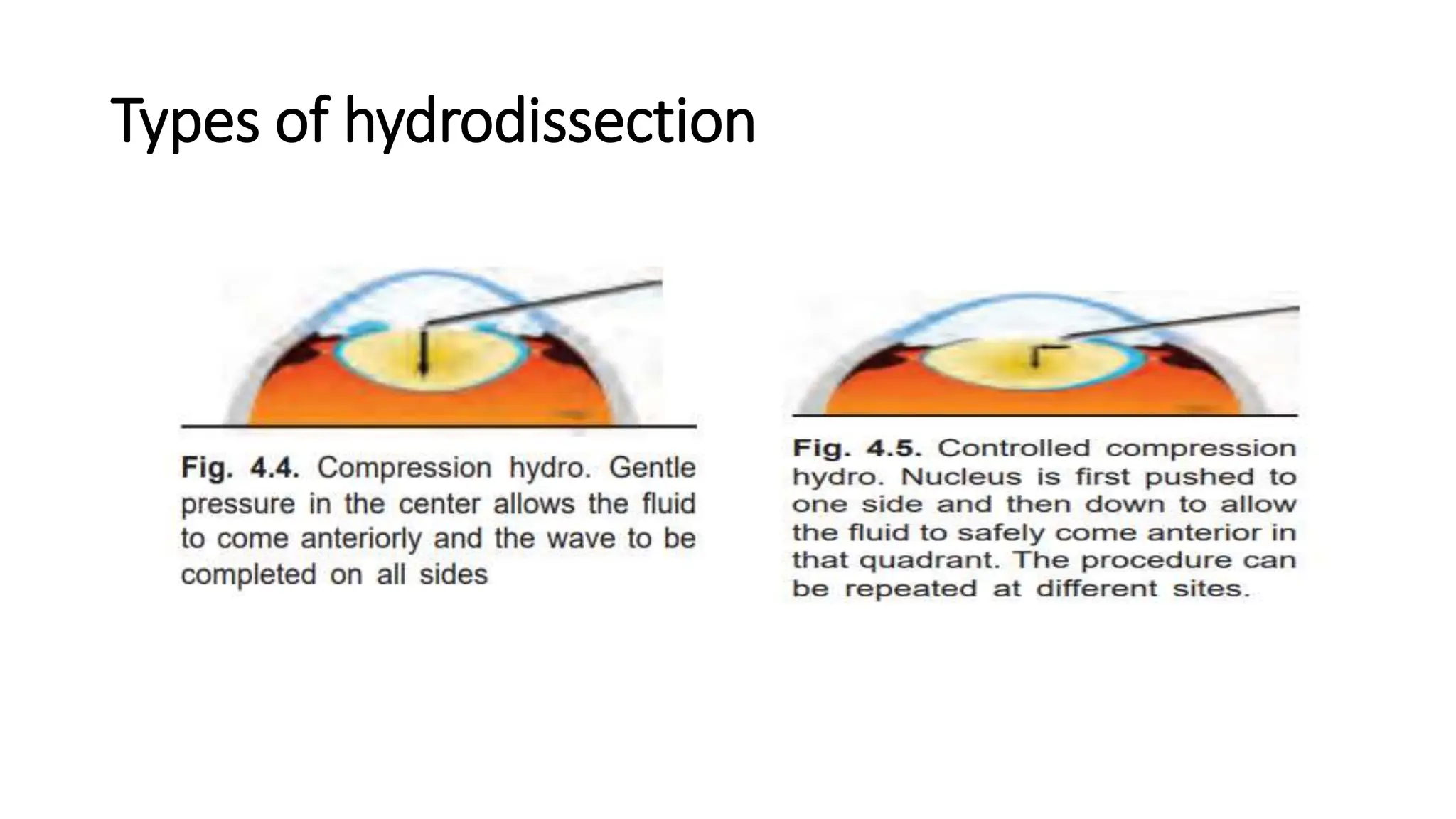 Phaco emulsification nuclear management techniques | PPTX