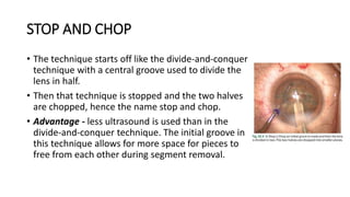 Phaco emulsification nuclear management techniques | PPTX