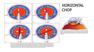 Phaco emulsification nuclear management techniques | PPTX