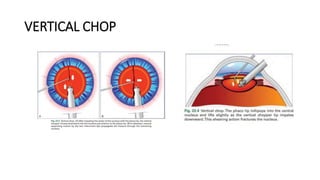 Phaco emulsification nuclear management techniques | PPTX