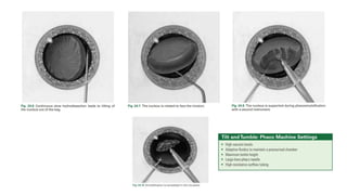 Phaco emulsification nuclear management techniques | PPTX