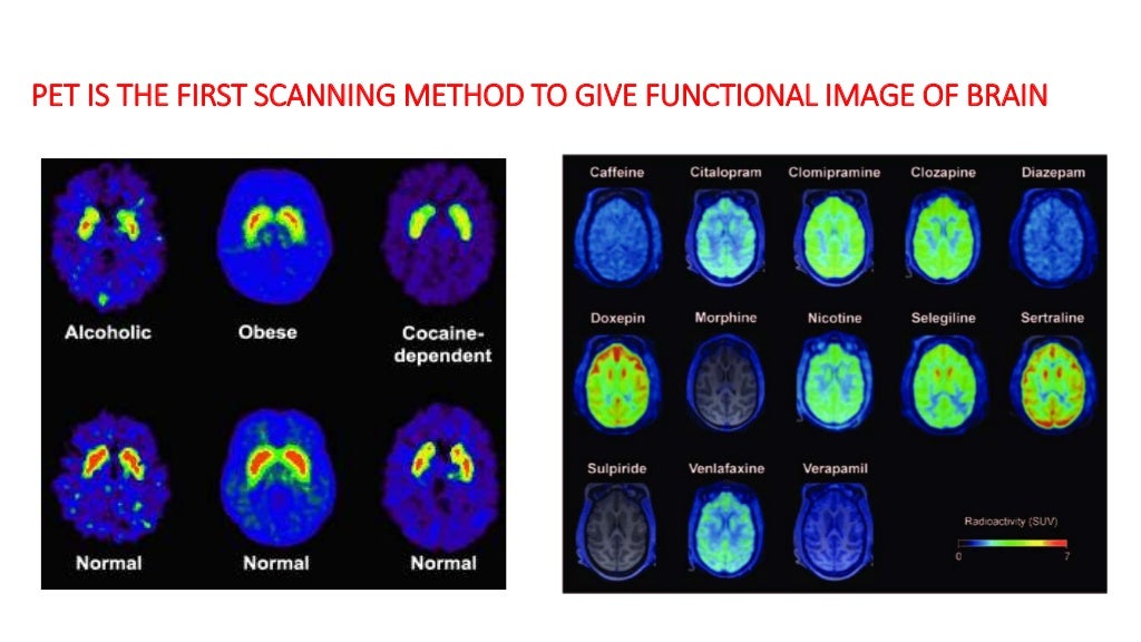 Nuclear medicine PET scan
