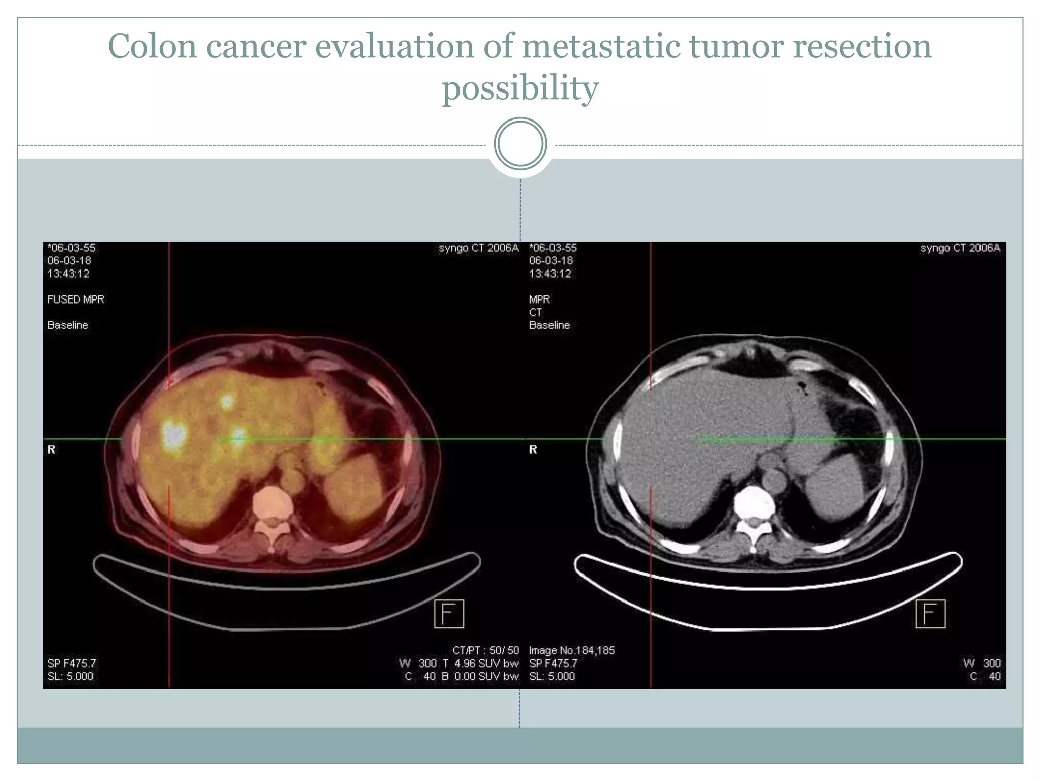 Nuclear medicine application in colorectal cancers | PPT
