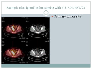 Nuclear medicine application in colorectal cancers | PPTX
